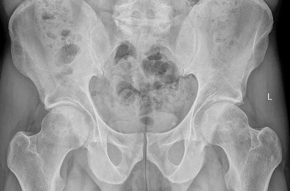 Rendgensko snimanje karlice sa kukovima - Rendgen karlice sa kukovima ...