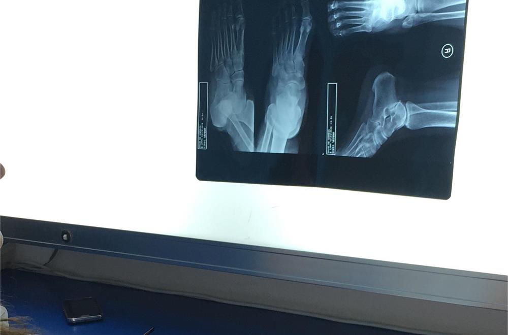 Snimanje skočnog zgloba na rendgen aparatu- RTG skočnog zgloba | Mr ...